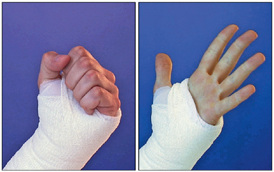 Øvelser for hånd i gips