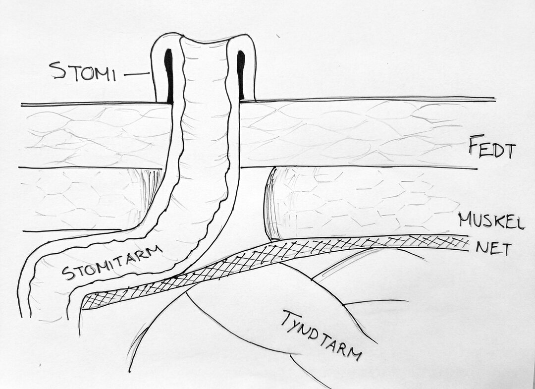 Brok ved stomi, operation for
