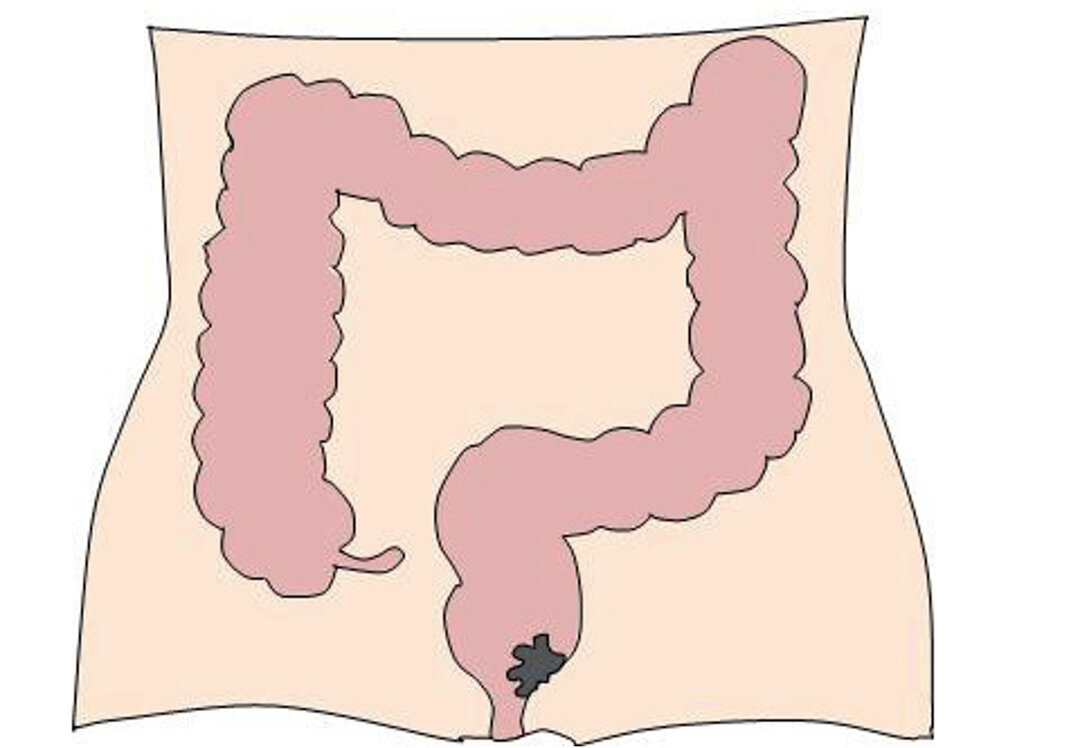 Kræft i endetarmen - information om operation med permanent stomi