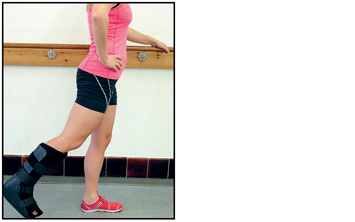 Underbenet/foden i gips eller bandage