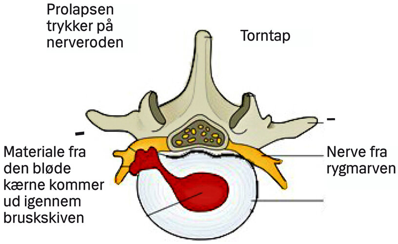 Discusprolaps i lænden