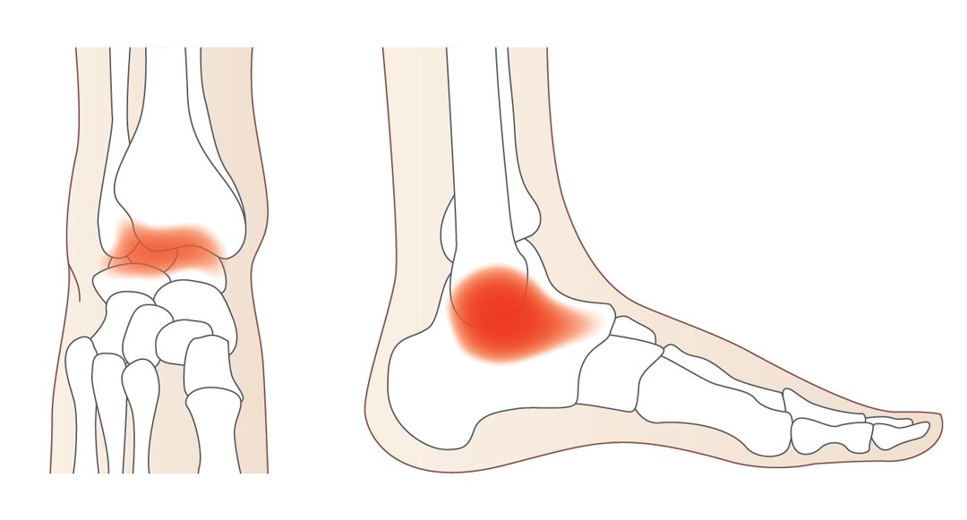 Slidgigt i anklen og bagfoden - Operation for