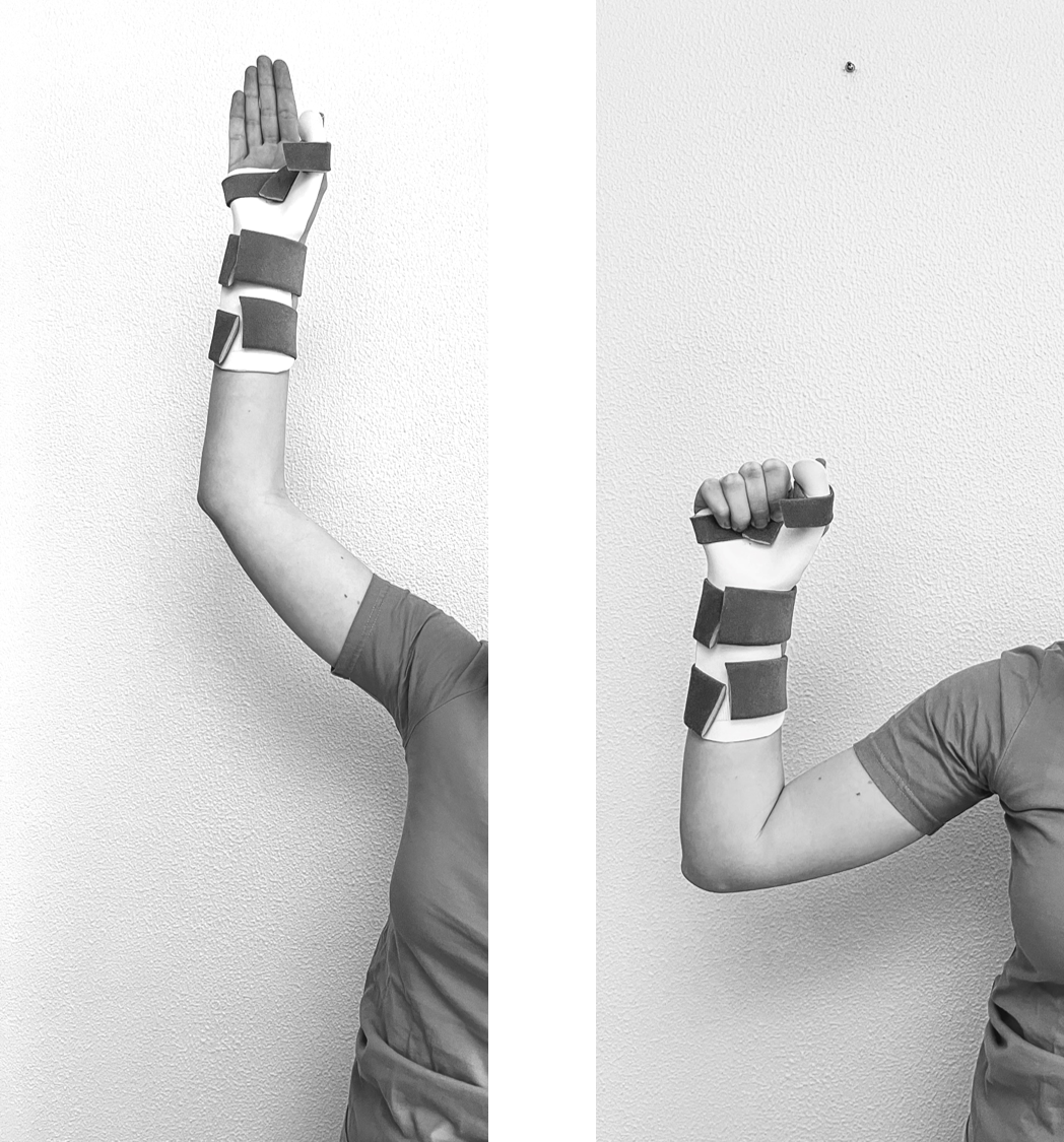 Øvelser efter operation for strækkesenelæsion i tommelen