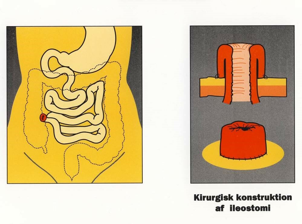 Når du får lavet stomi