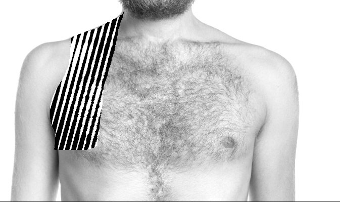 Port-a-Cath, anlæggelse af