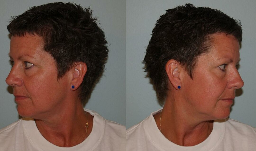 Svimmelhedsøvelser, Niveau 3