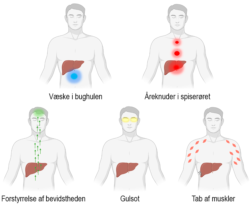 Skrumpelever (levercirrose)