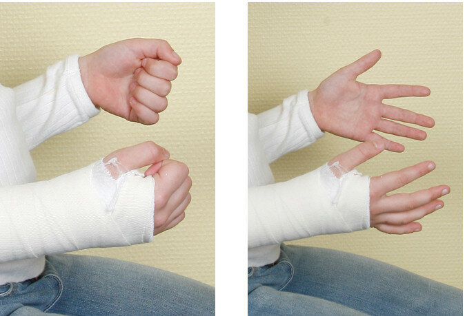 Mit barn har brækket hånden