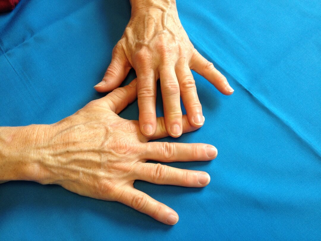 Artrose - håndtræning til patienter