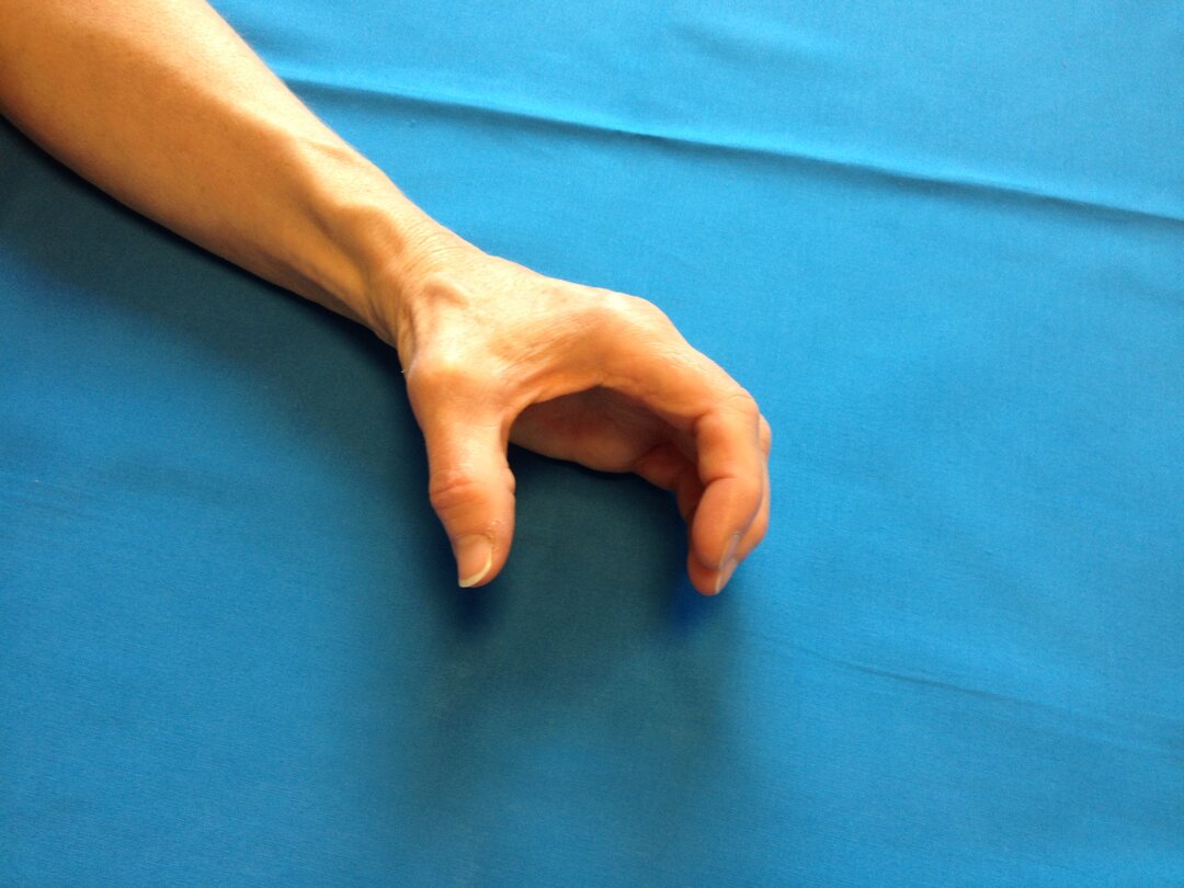 Artrose - håndtræning til patienter