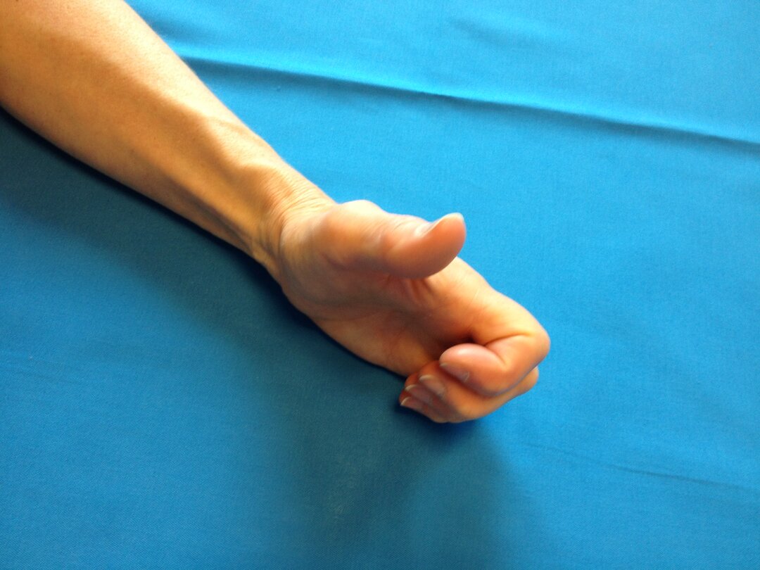 Artrose - håndtræning til patienter