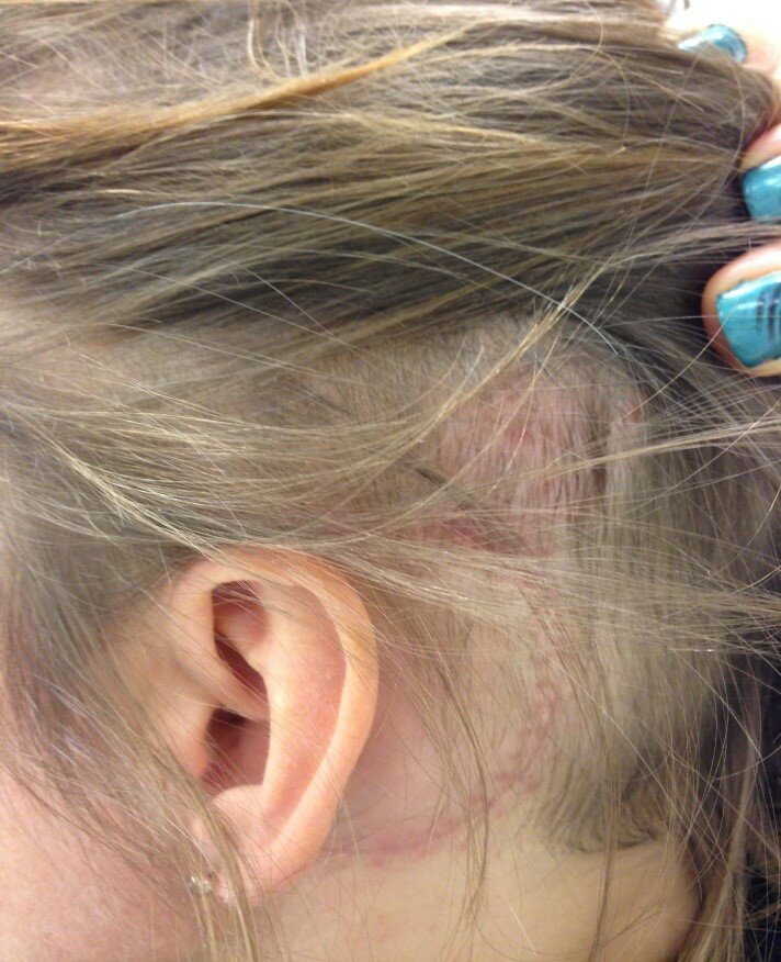 Godartet knude på hørenerven (vestibularis schwannom) - information om ...