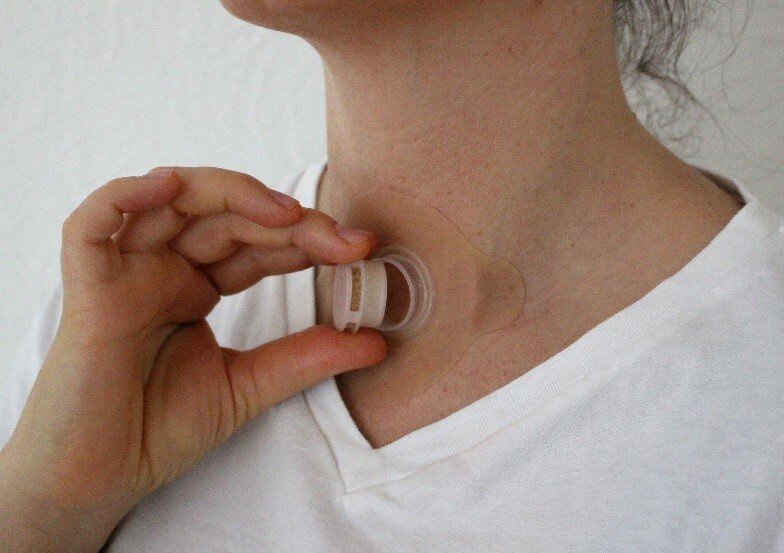 Pleje ved fjernelse af struben med LaryTube