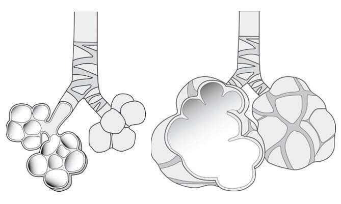 Lungevolumenreduktion med ventiler ved lungeemfysem