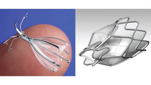 Lungevolumenreduktion med ventiler ved lungeemfysem