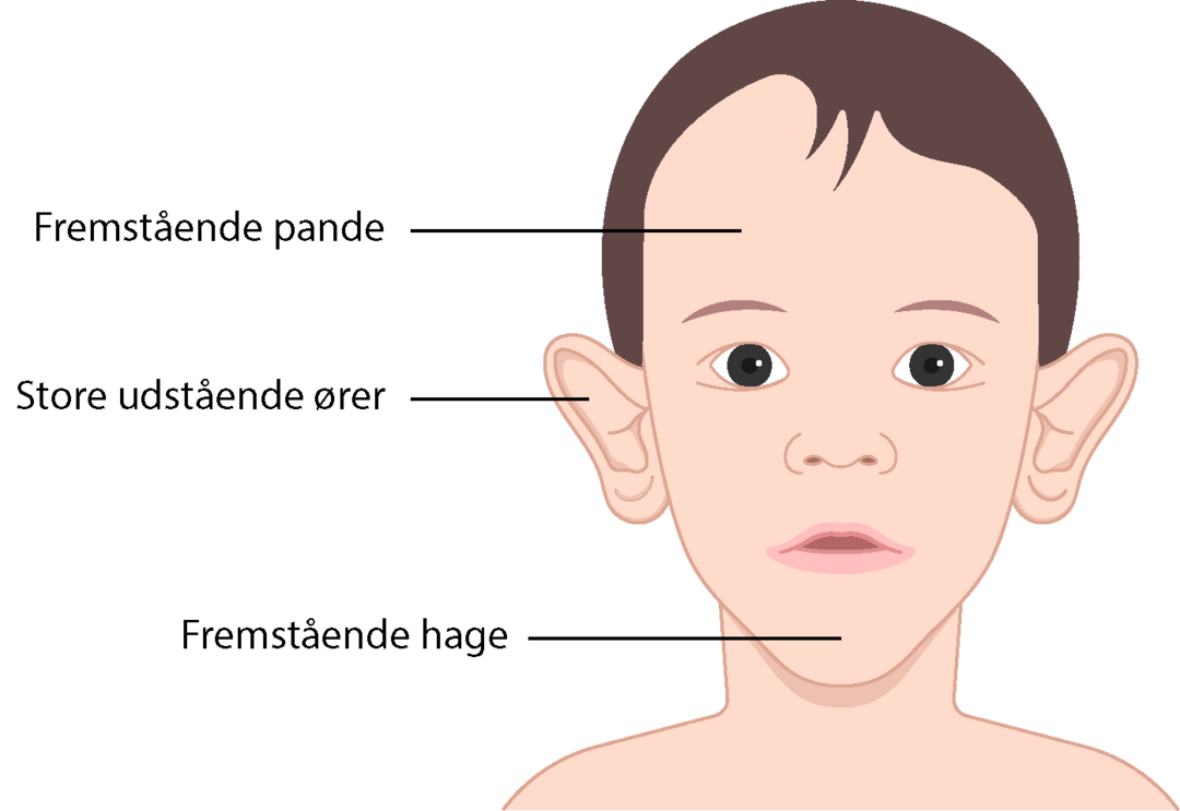 Introduktion til Fragilt X Syndrom