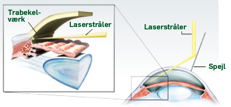 Laserbehandling til at sænke trykket i øjet - Grøn stær