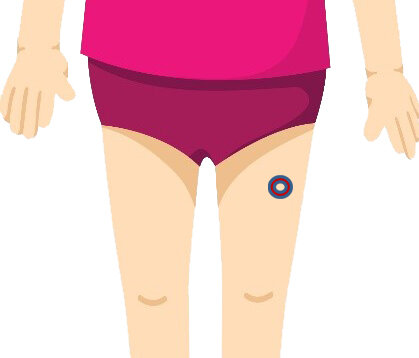 Muskelbiopsi - information til patient og forældre