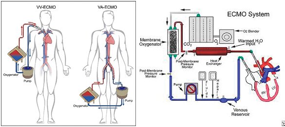 ECMO-behandling