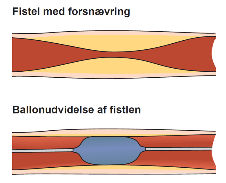 AV-fistel, behandling af