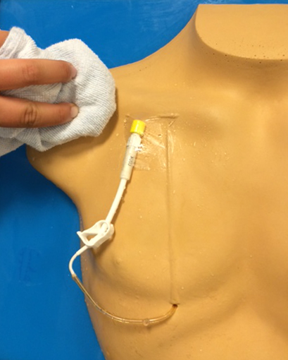 Tunneleret Centralt Venekateter