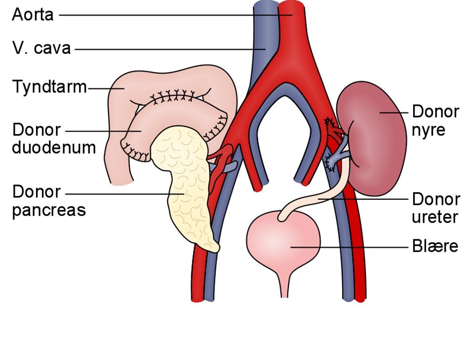 Kombineret nyre- og pancreas-transplantation
