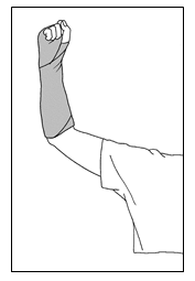 Armen i gips, Afdeling for Led- og Knoglekirurgi