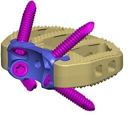 Synfix - stabiliserende operation med